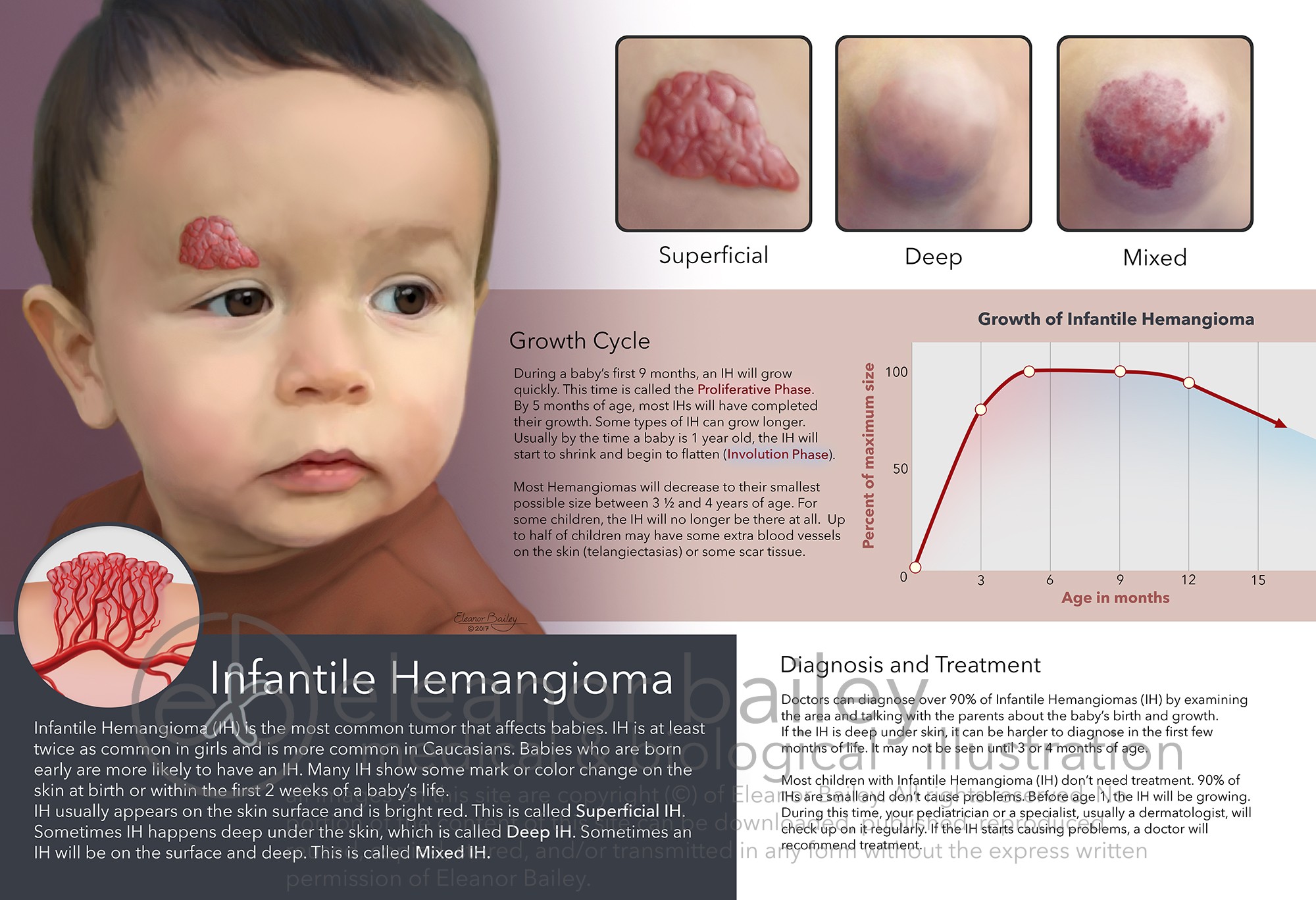 Infantile Hemangioma Eleanor Bailey Illustration